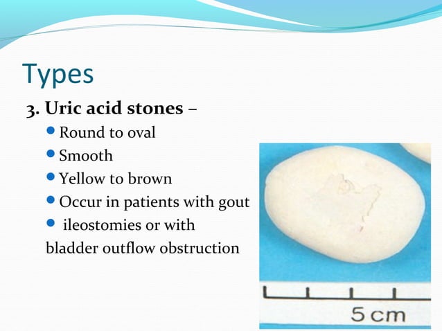 Bladder calculi | PPT | Digestive Disorders | Diseases and Conditions