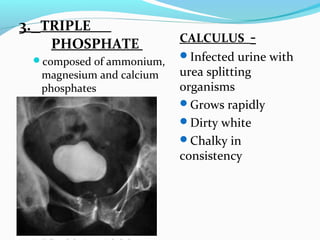 Bladder calculi | PPT
