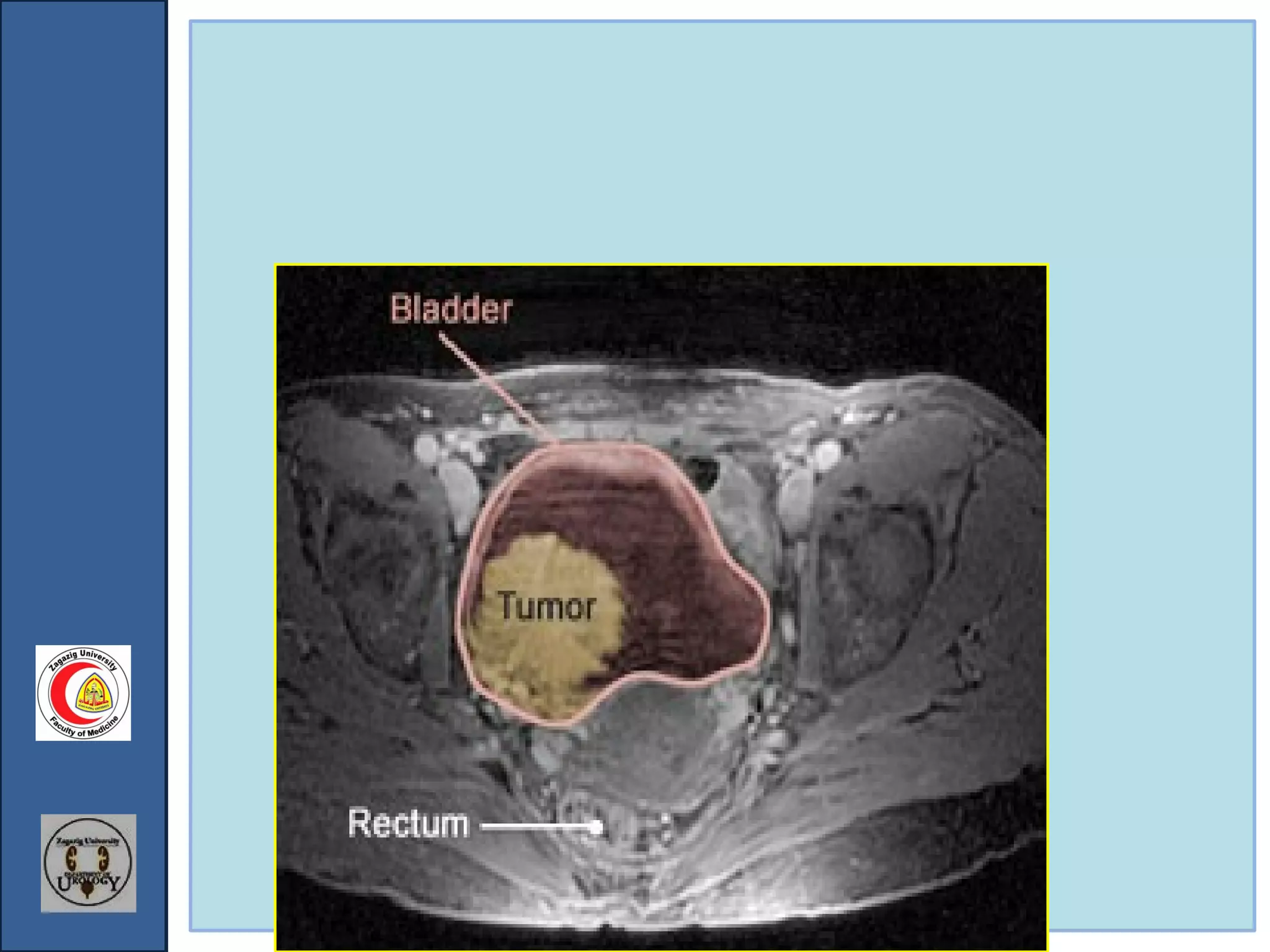 Introduction to Bladder Cancer | PPT