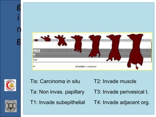Introduction to Bladder Cancer | PPT