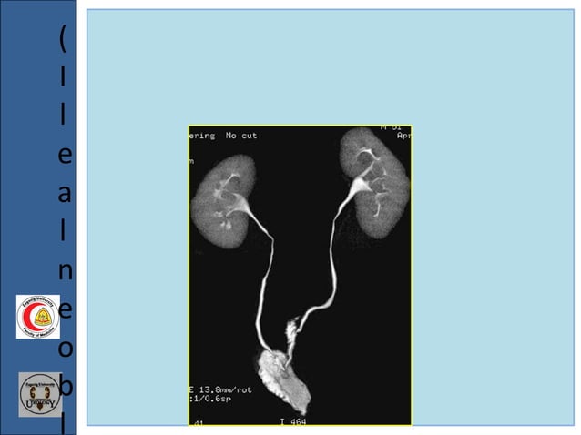 Introduction to Bladder Cancer | PPT