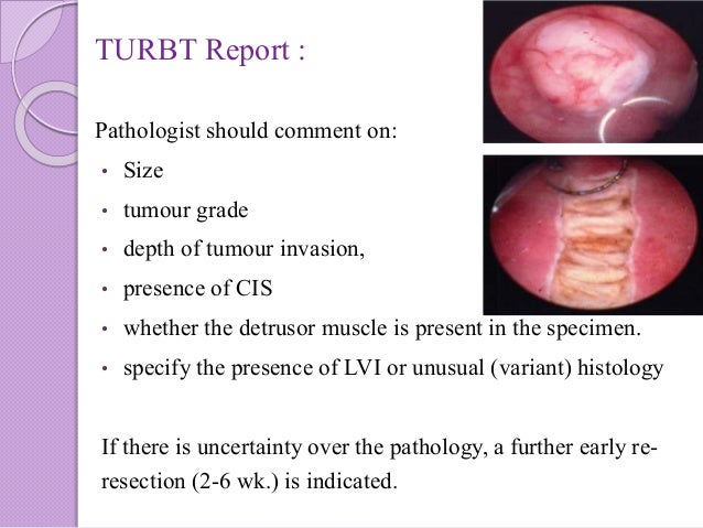 Bladder cancer