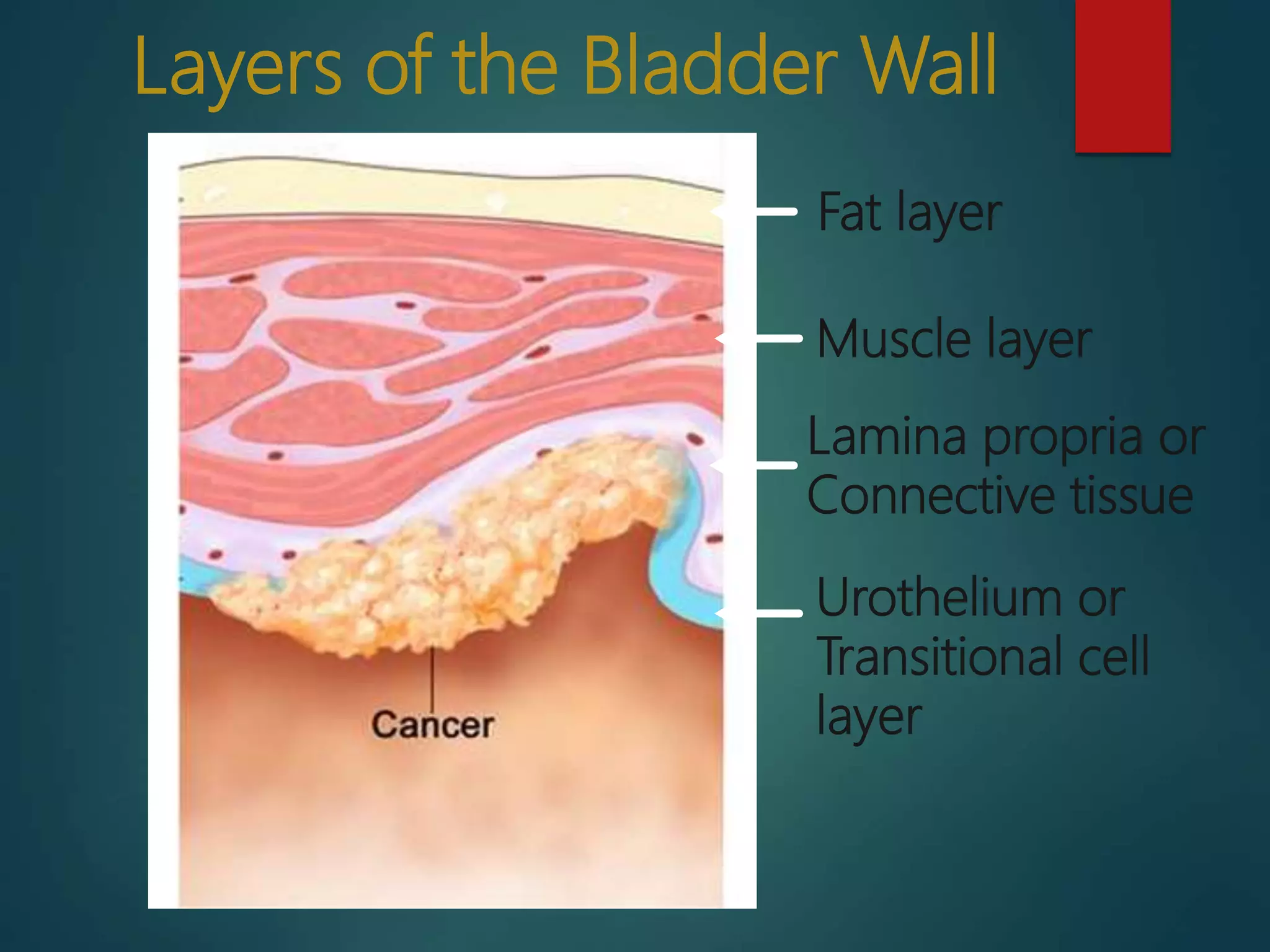 Bladder cancer. | PPTX