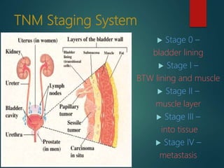 Bladder cancer. | PPT