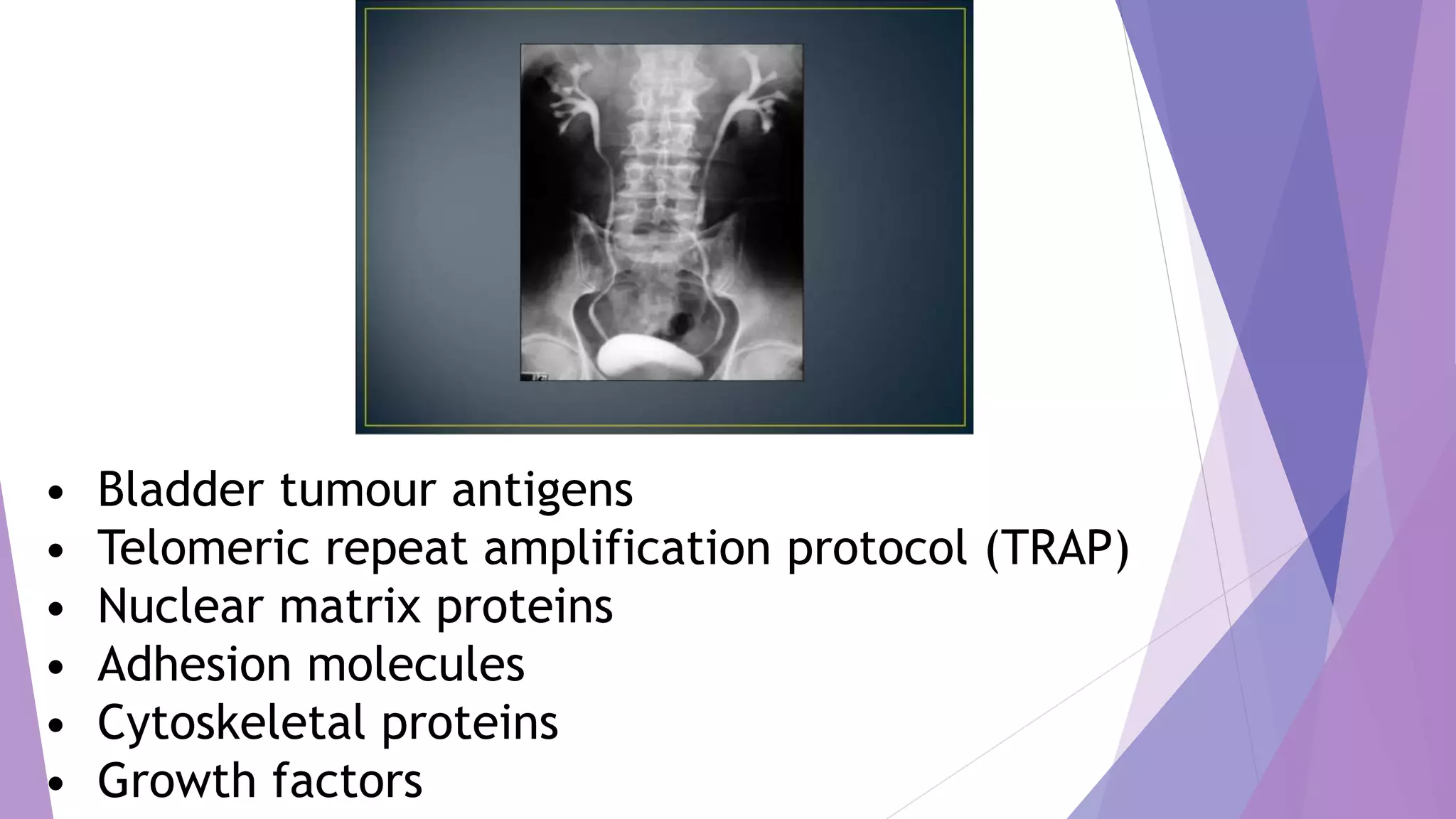 Bladder cancer and its management | PPTX