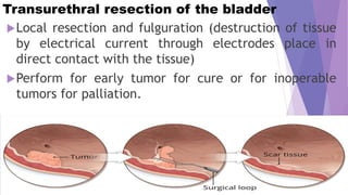 Bladder cancer and its management | PPTX
