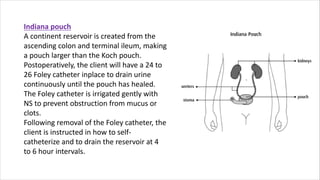 Bladder cancer | PDF