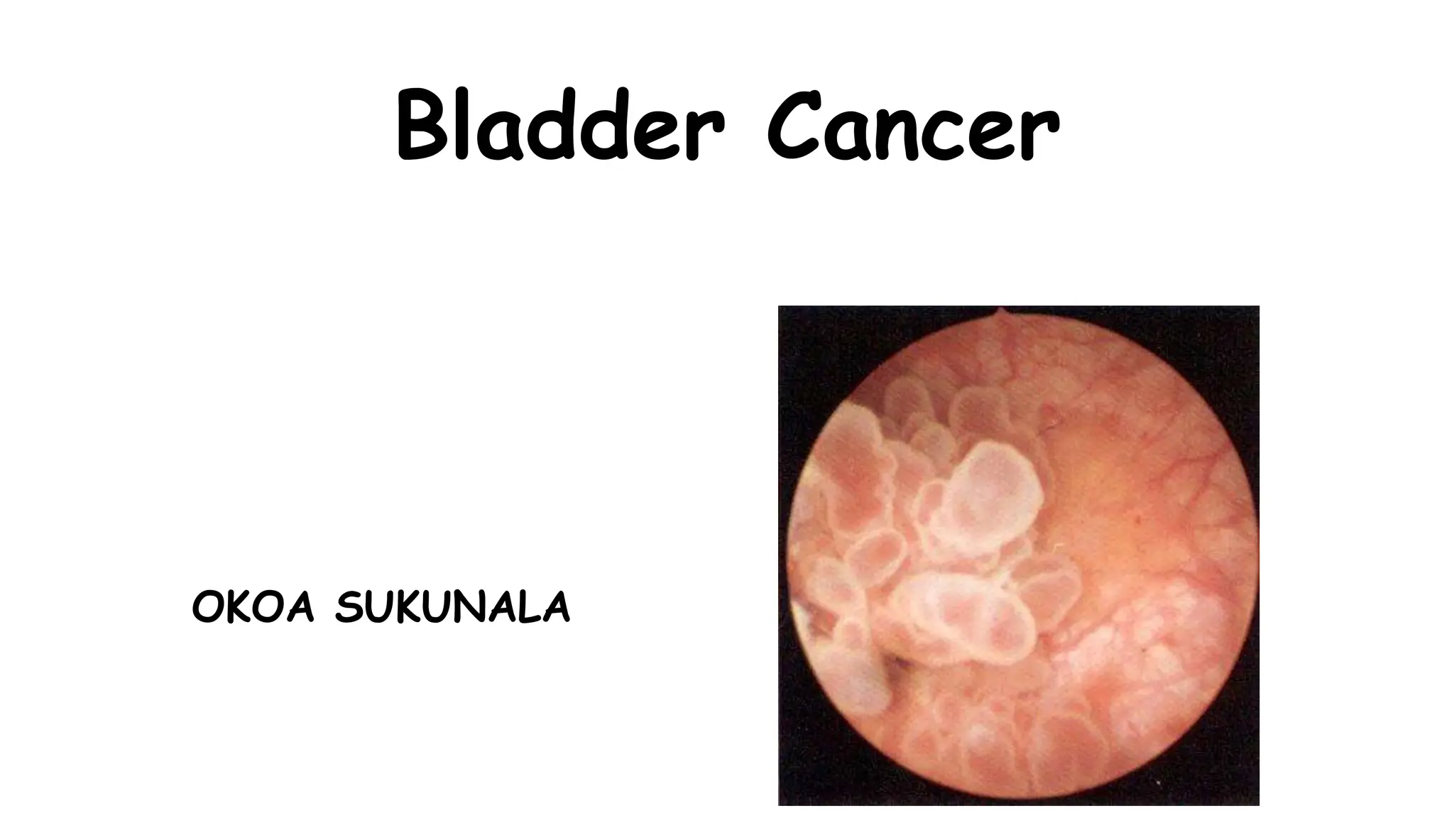 Bladder Cancer risk factors pathophysiology and treatment | PPT