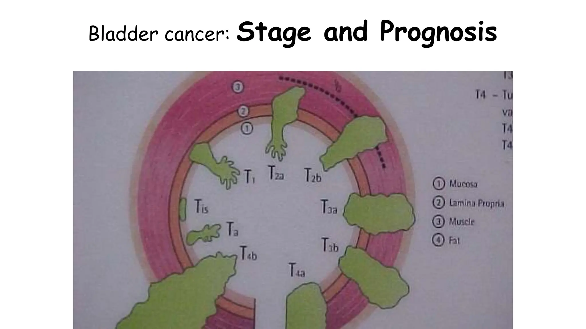 Bladder Cancer risk factors pathophysiology and treatment | PPTX
