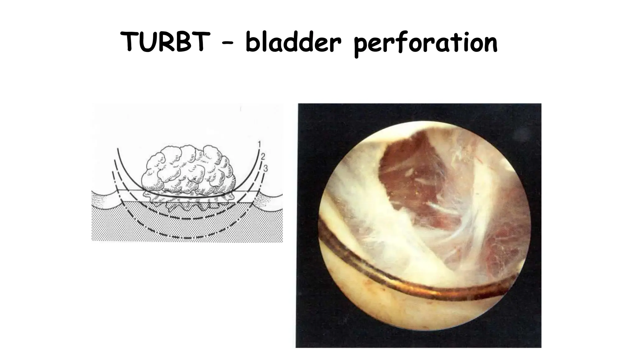 Bladder Cancer risk factors pathophysiology and treatment | PPTX
