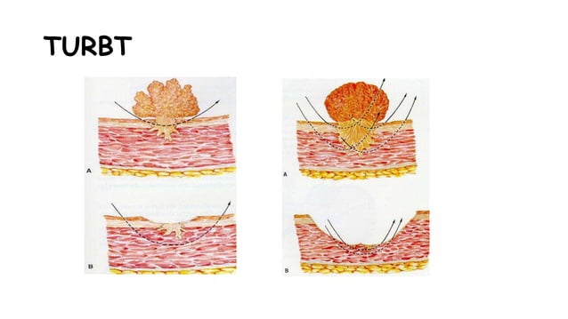 Bladder Cancer risk factors pathophysiology and treatment | PPT