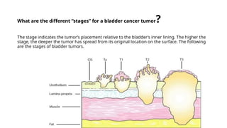 bladder cancer for nurses students presentation | PPTX