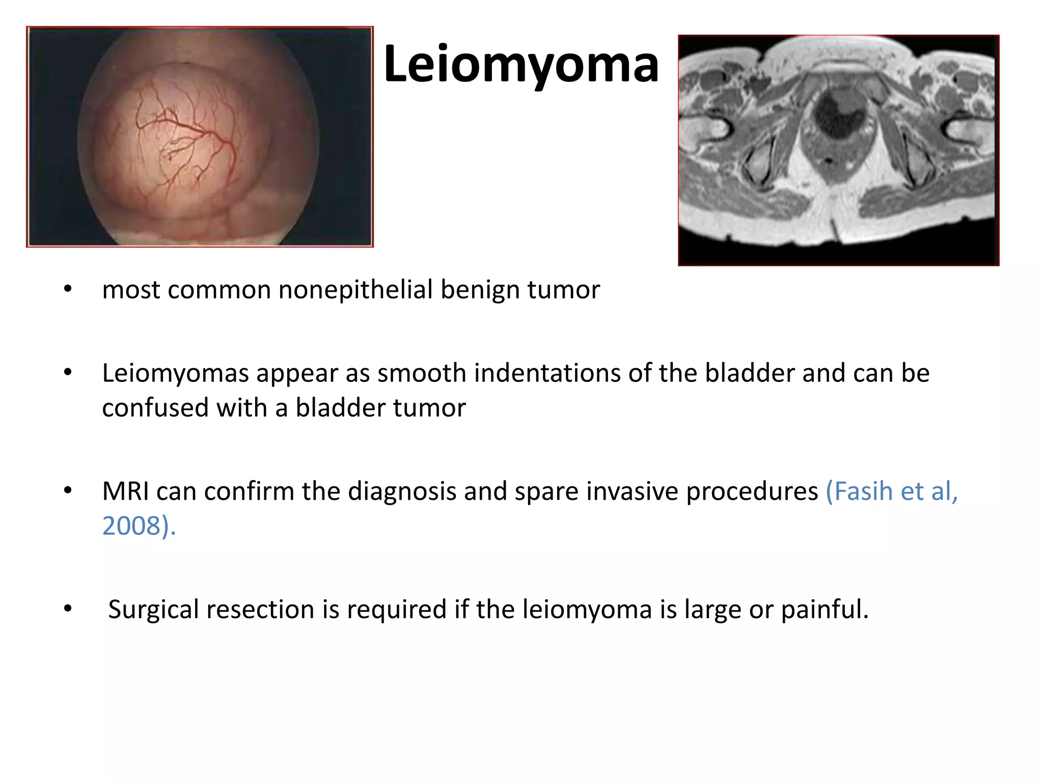 Urinary bladder carcinoma | PPTX