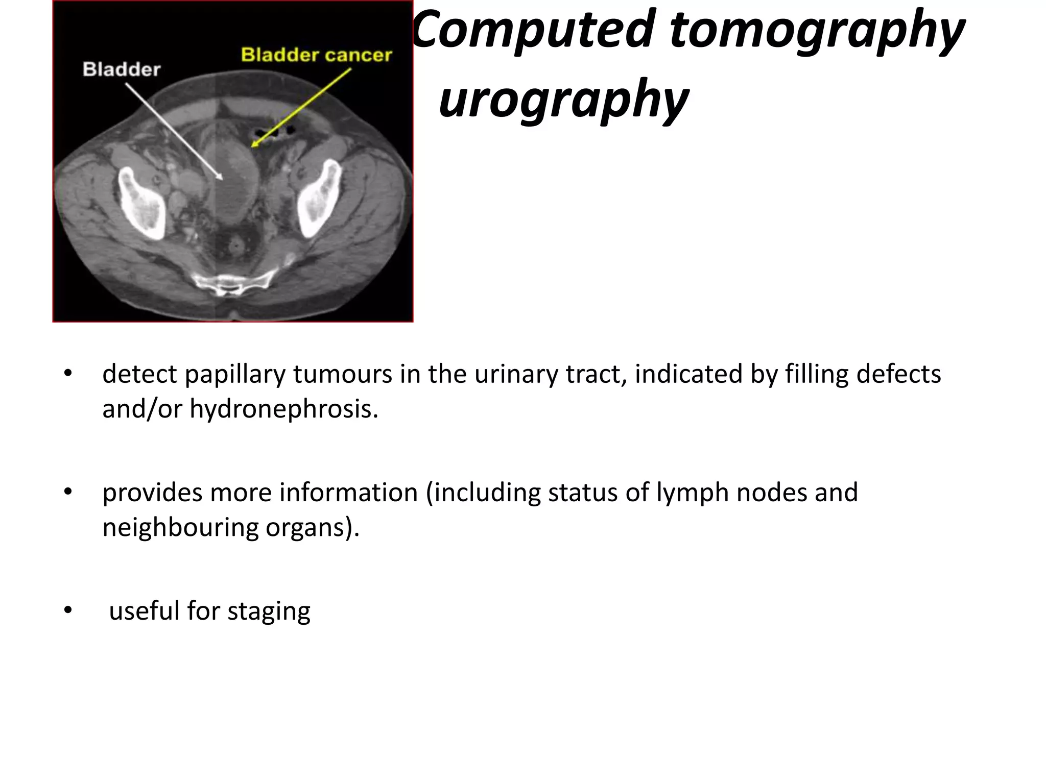 Urinary bladder carcinoma | PPTX