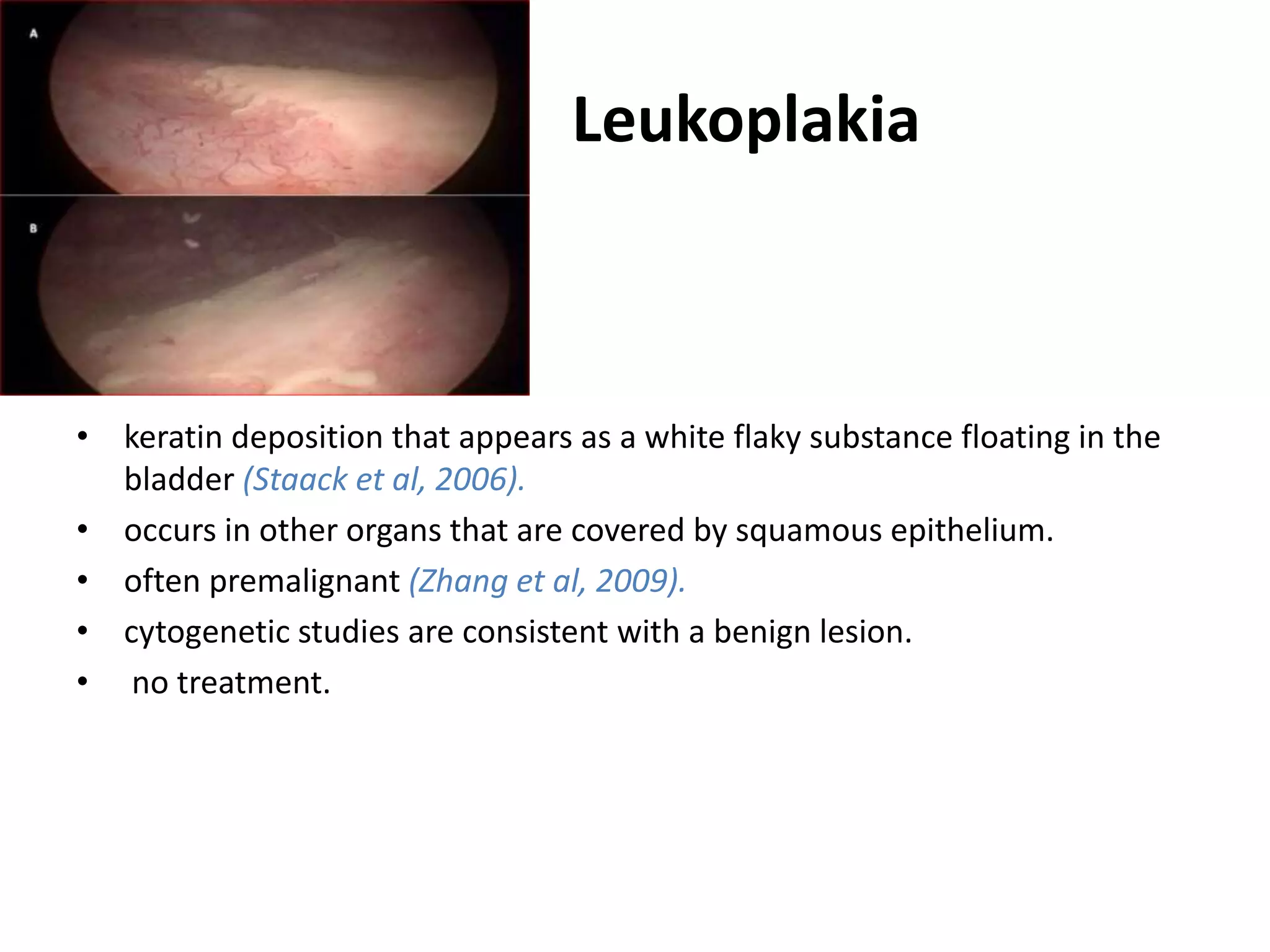 Urinary bladder carcinoma | PPTX
