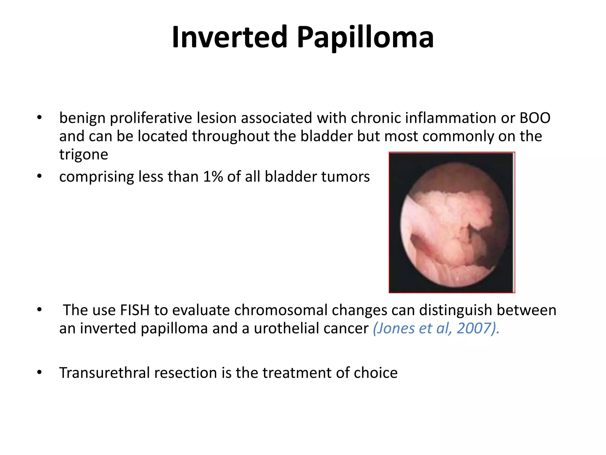 Urinary bladder carcinoma | PPTX