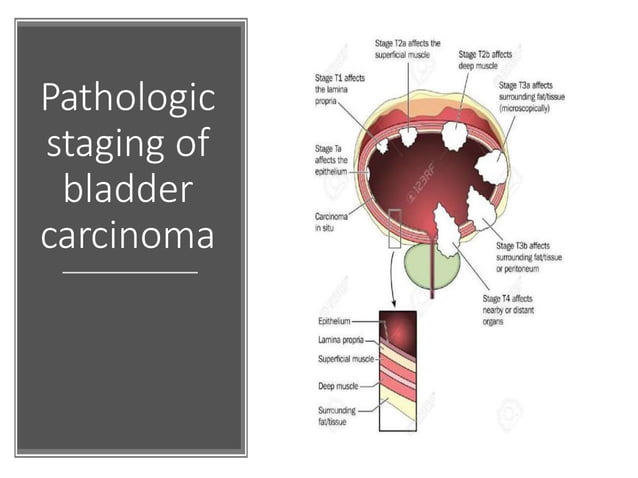 Urinary bladder carcinoma | PPTX | Cancer | Diseases and Conditions