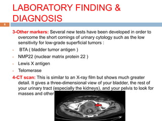 Bladder cancer | PPTX