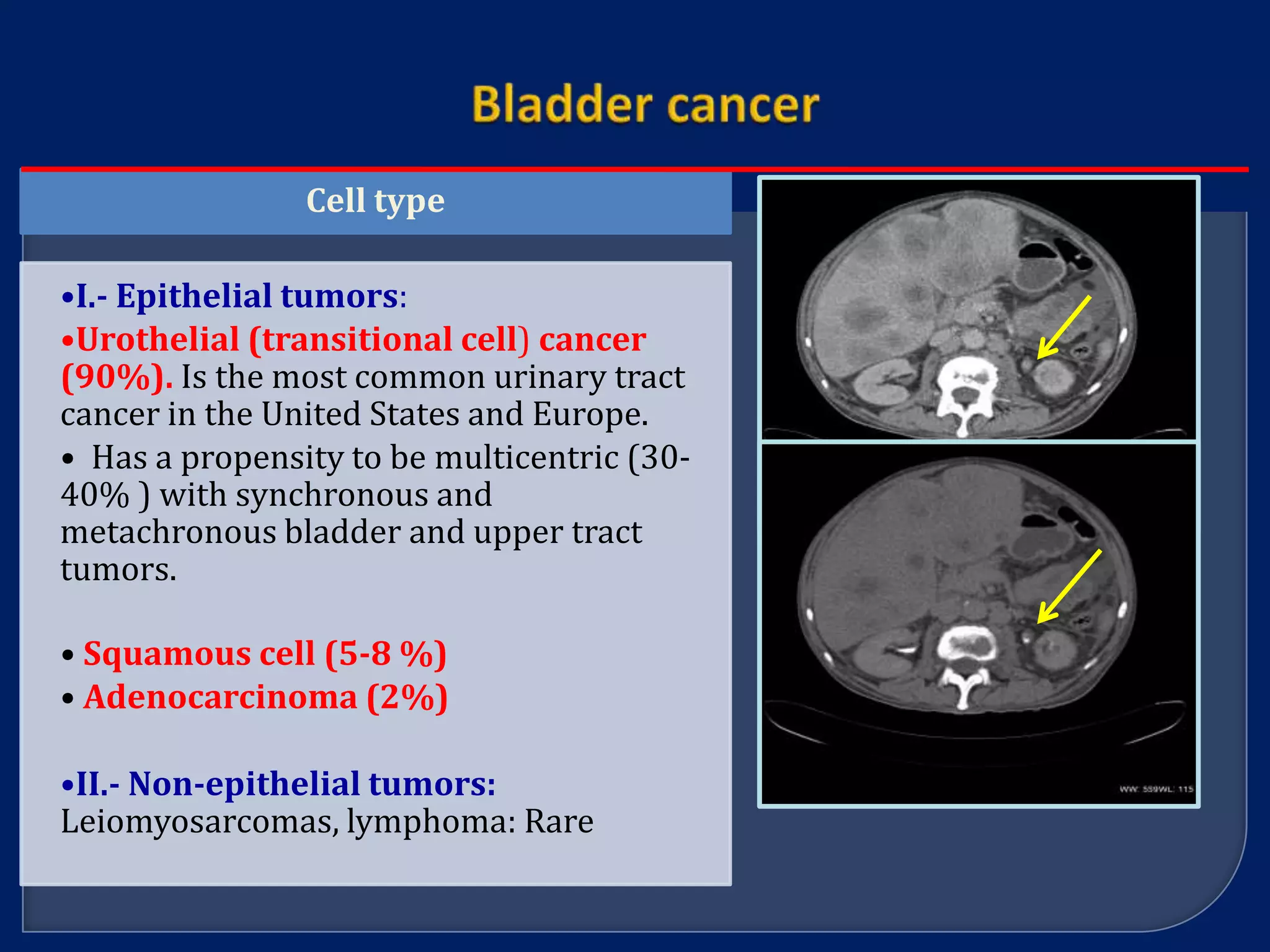 Role of CT Urography in bladder cancer. Cambridge lecture. | PPTX