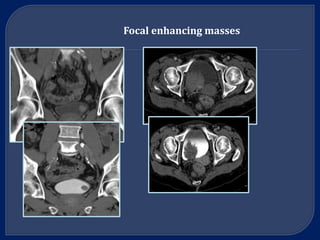 Role of CT Urography in bladder cancer. Cambridge lecture. | PPTX