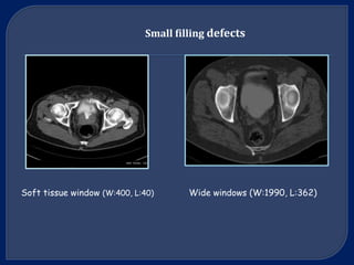 Role of CT Urography in bladder cancer. Cambridge lecture. | PPTX
