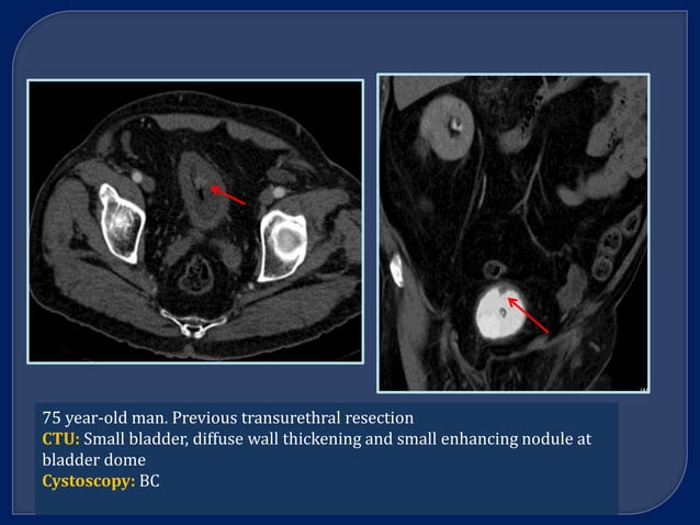 Role of CT Urography in bladder cancer. Cambridge lecture. | PPT