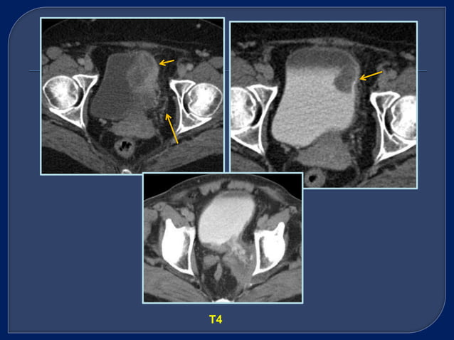 Role of CT Urography in bladder cancer. Cambridge lecture. | PPT