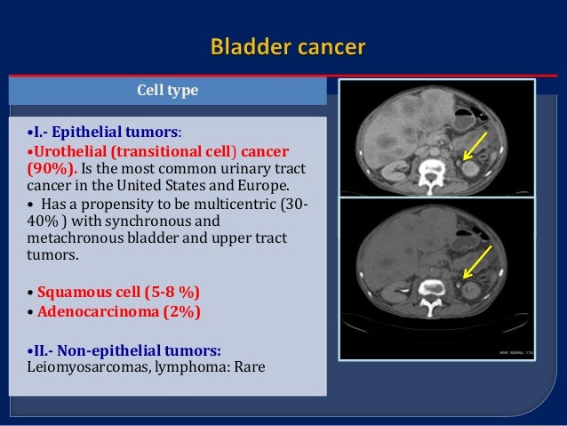 Role Of Ct Urography In Bladder Cancer Cambridge Lecture