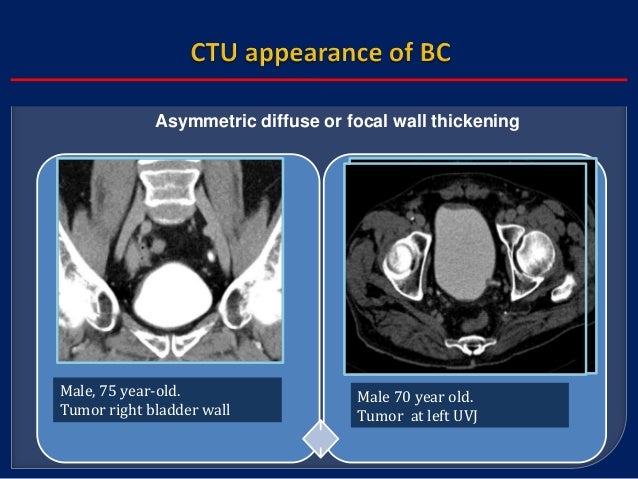 Role Of Ct Urography In Bladder Cancer Cambridge Lecture
