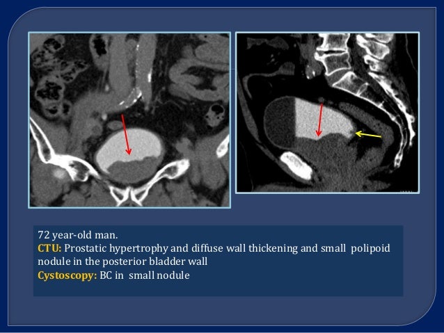 Role Of Ct Urography In Bladder Cancer Cambridge Lecture