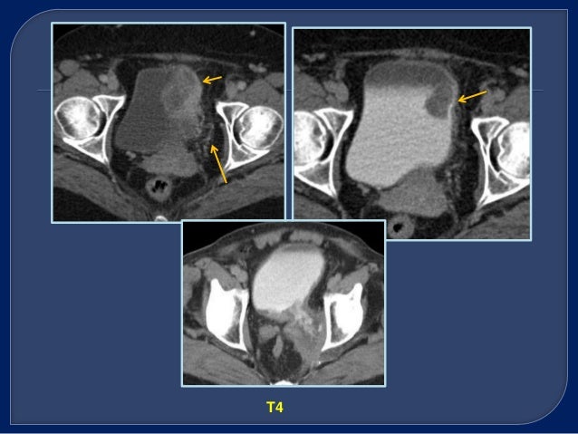 Role Of Ct Urography In Bladder Cancer Cambridge Lecture
