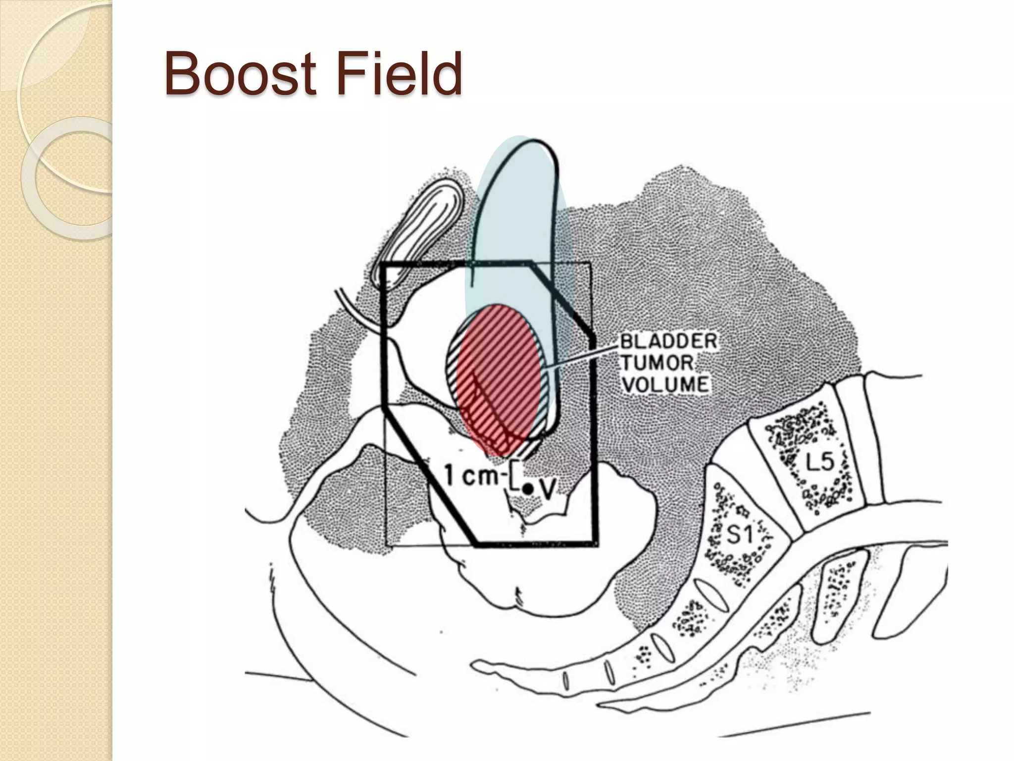 Radiation for the Treatment of Bladder Cancer | PPTX
