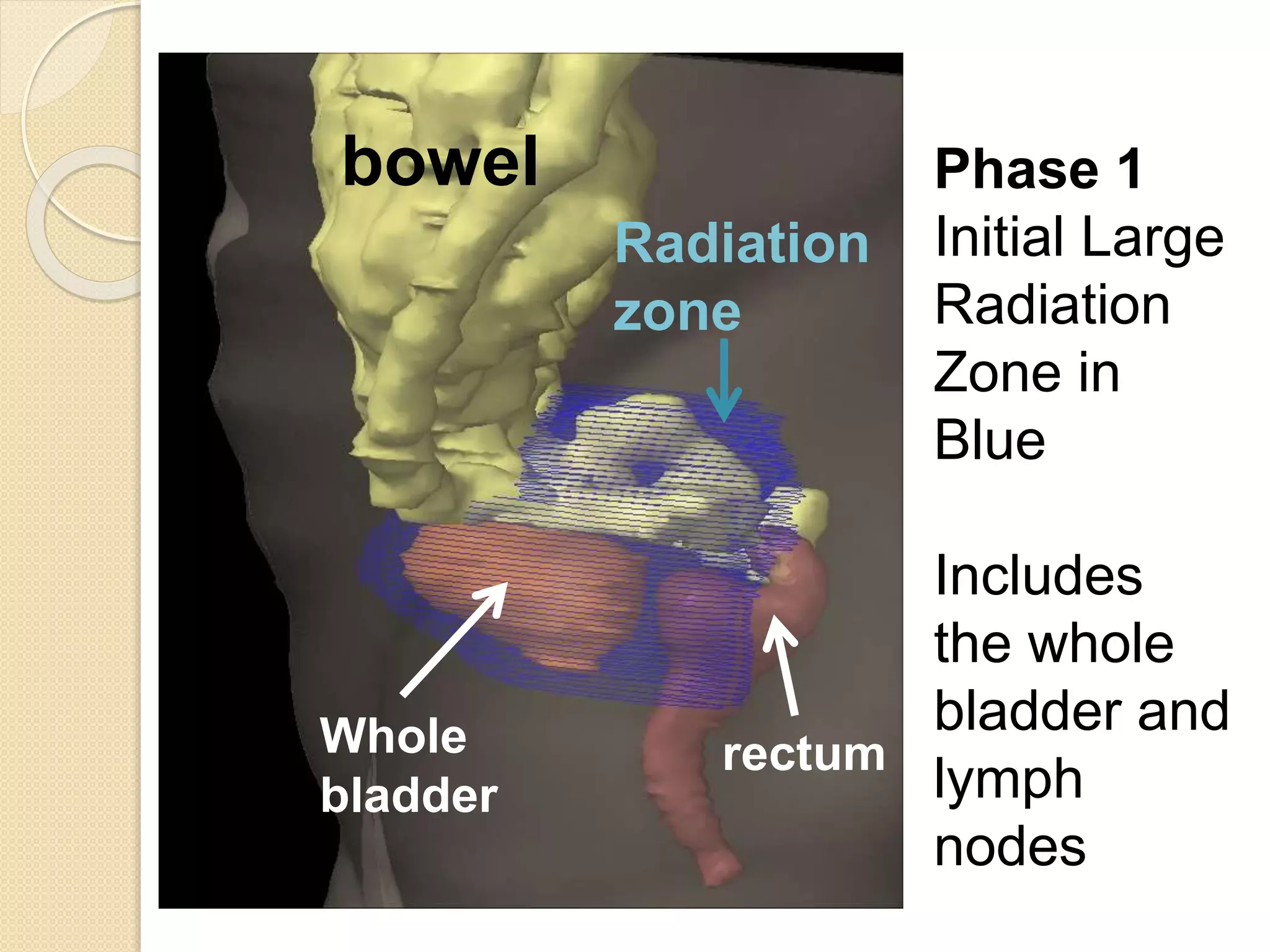 Radiation for the Treatment of Bladder Cancer | PPTX