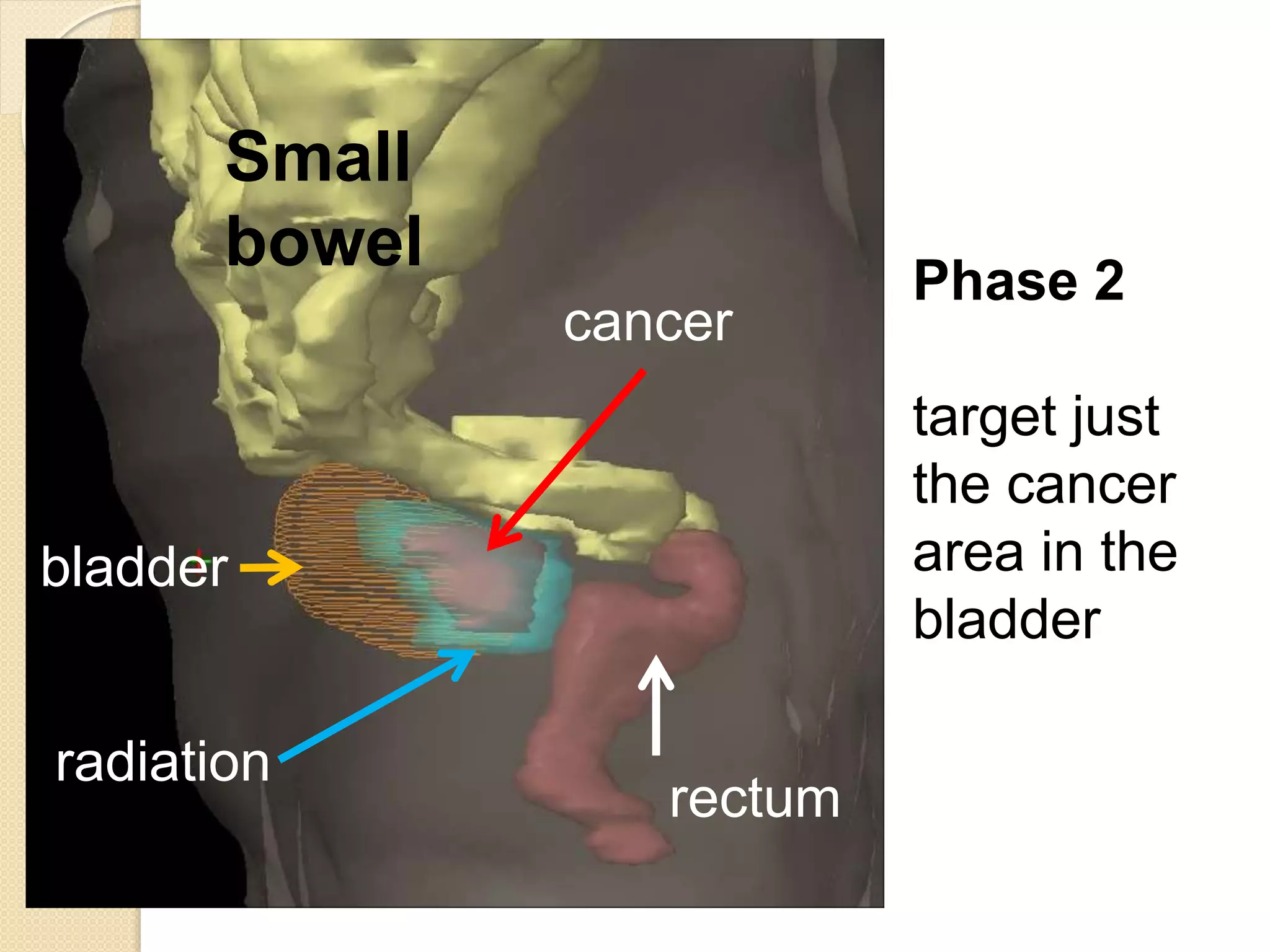Radiation for the Treatment of Bladder Cancer | PPTX