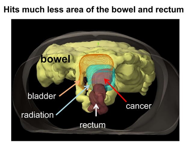 Radiation for the Treatment of Bladder Cancer | PPTX