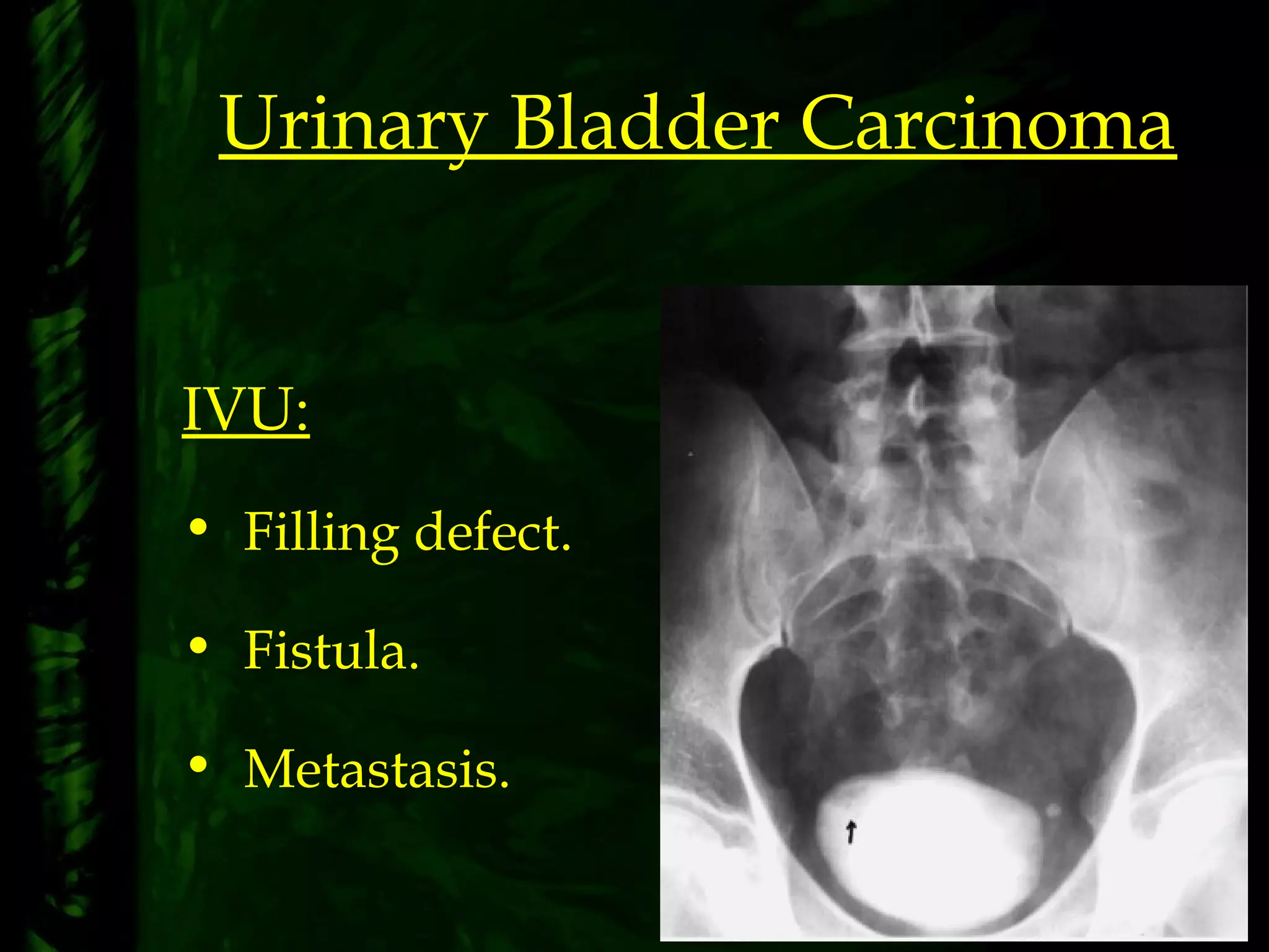Bladder carcinoma | PPT