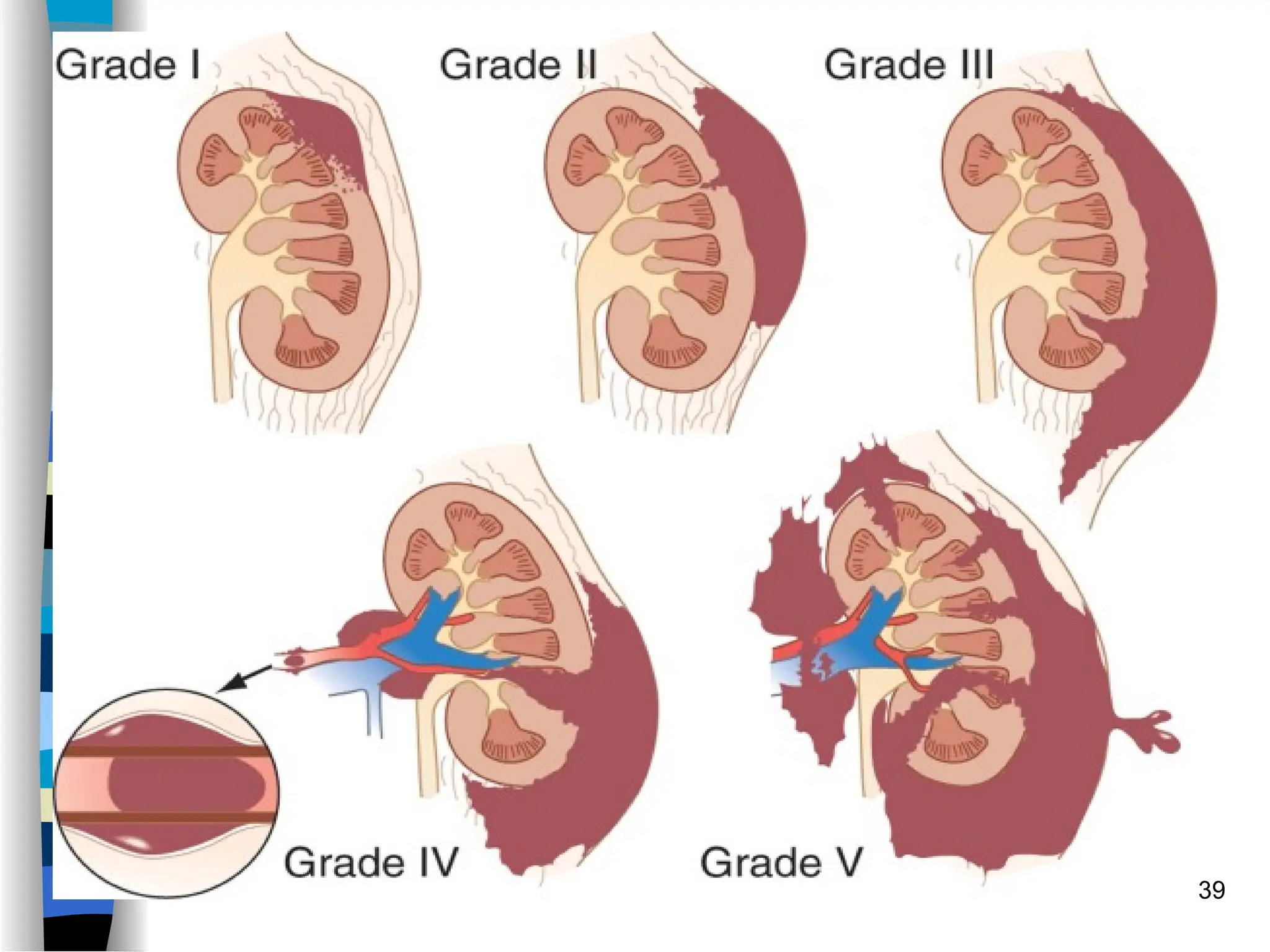 BLADDER,COLON, RECTAL INJURIES KIDNEY INJURIES-1.ppt