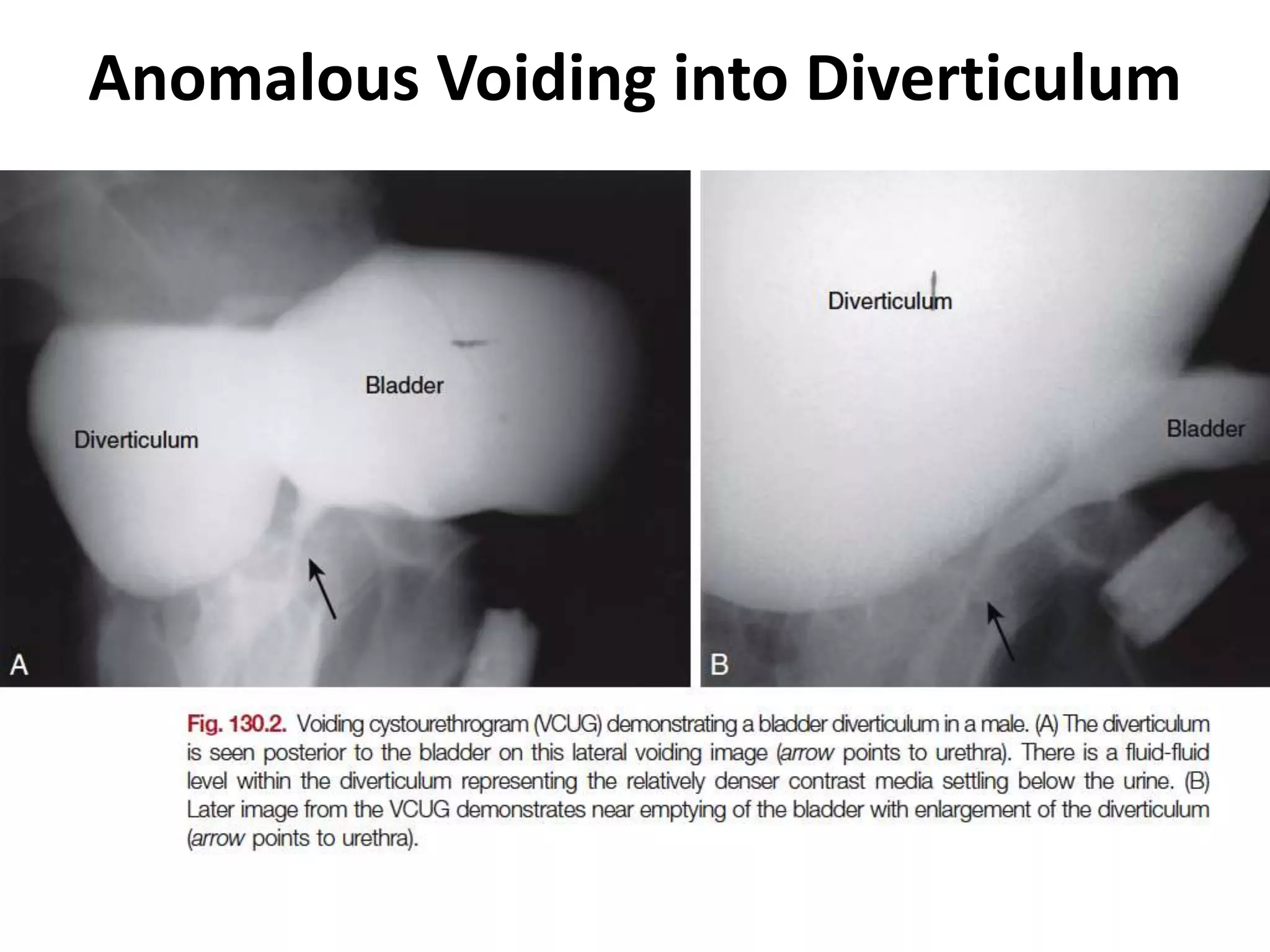 Bladder diverticulum | PPTX