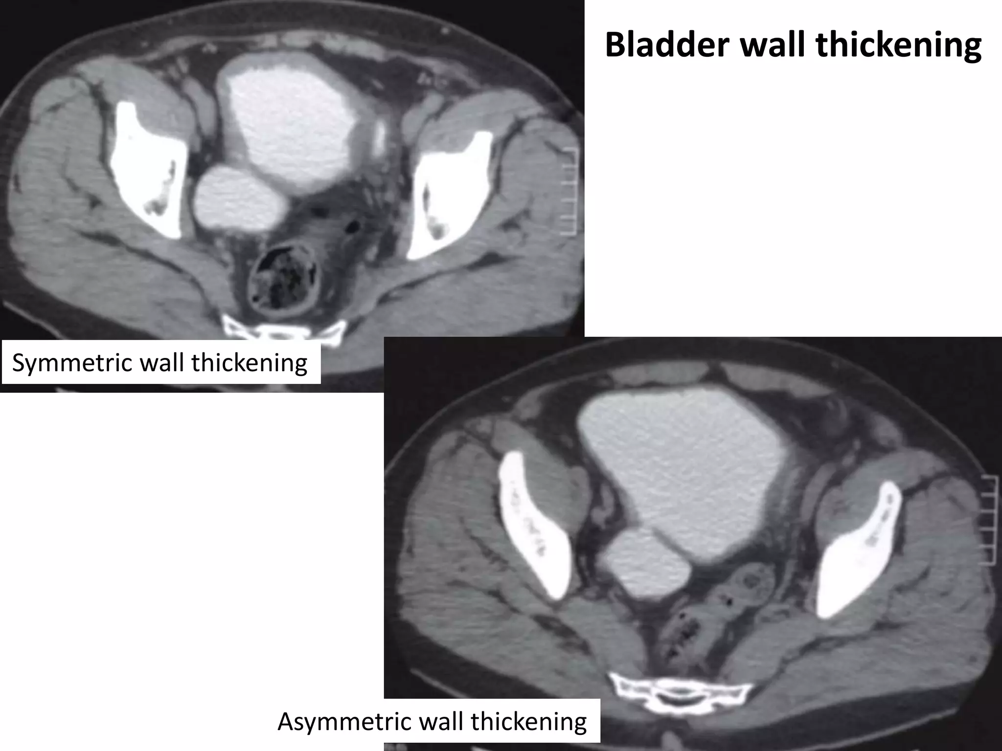 Bladder diverticulum | PPTX
