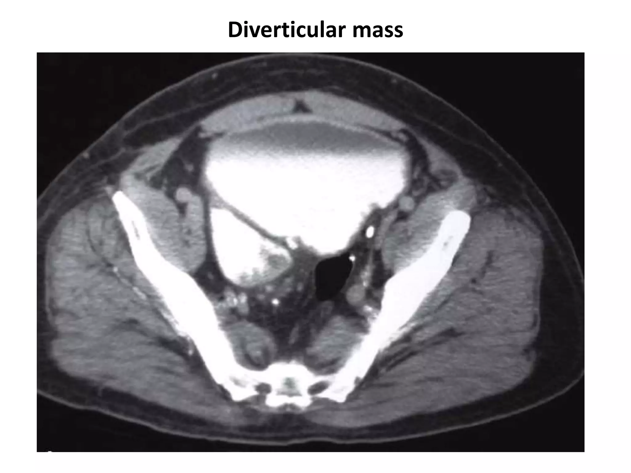 Bladder diverticulum | PPTX