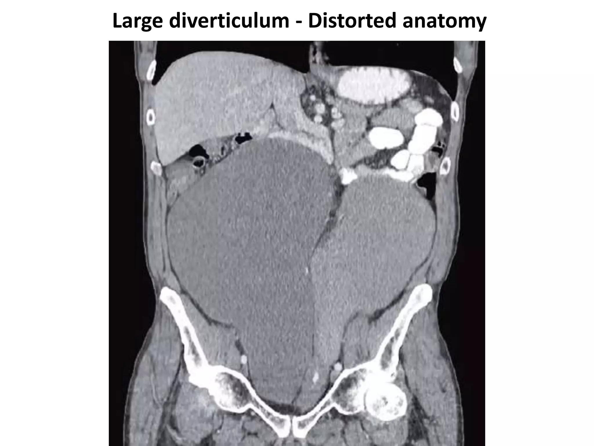 Bladder diverticulum | PPTX