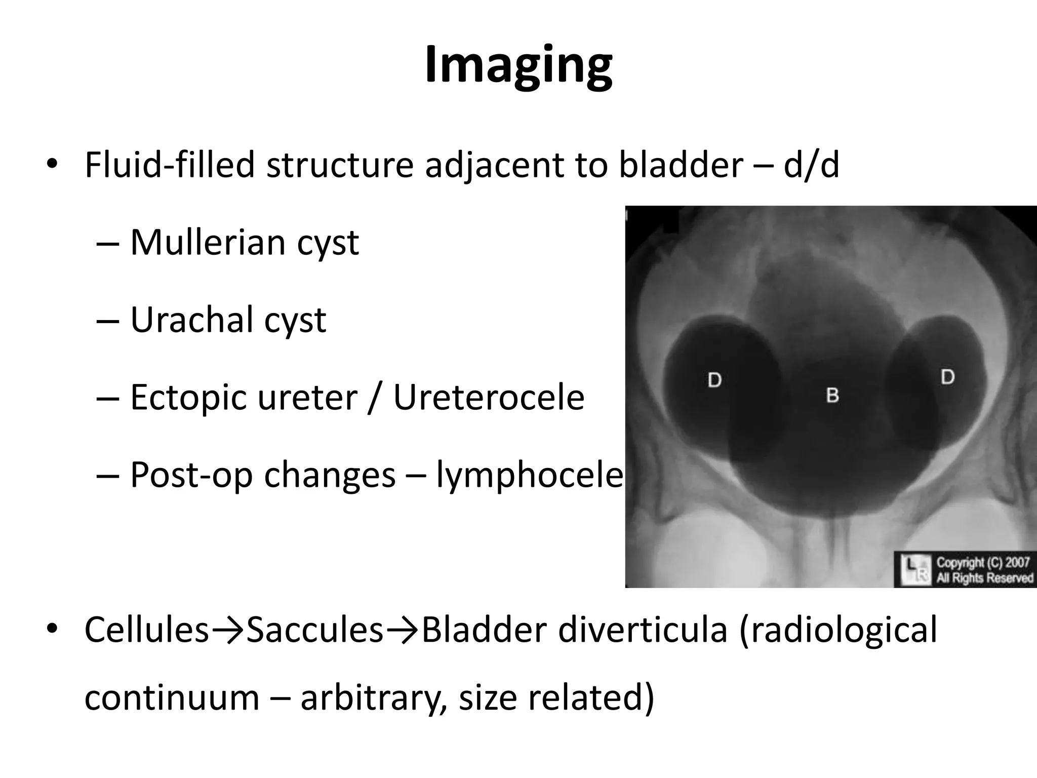 Bladder diverticulum | PPTX