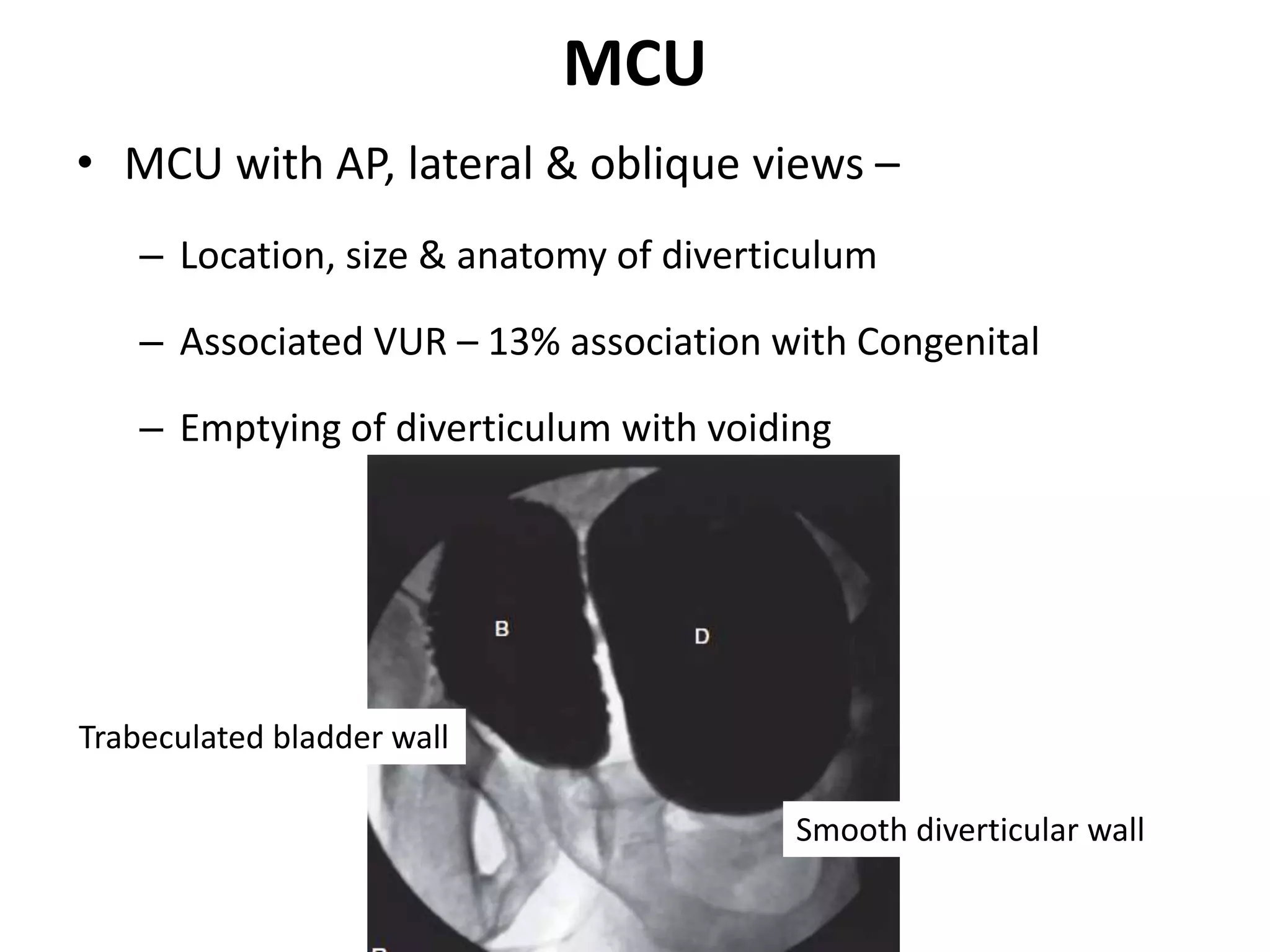 Bladder diverticulum | PPTX