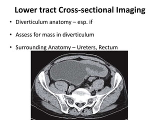 Bladder diverticulum | PPTX