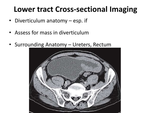 Bladder diverticulum | PPTX