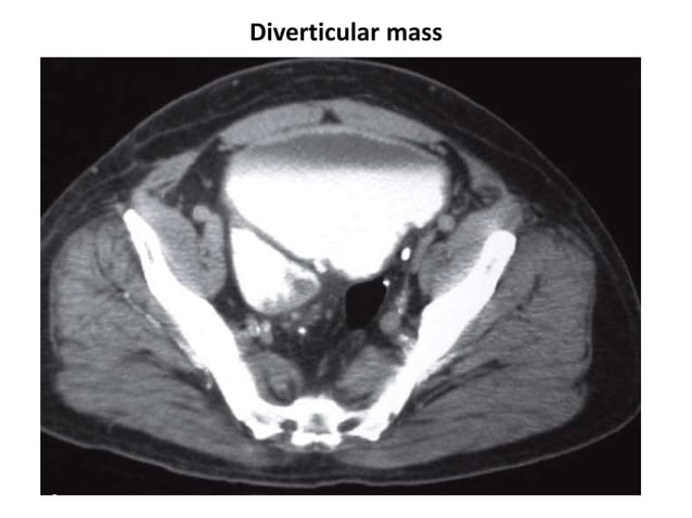Bladder diverticulum | PPTX