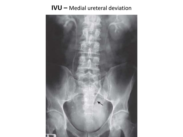 Bladder diverticulum | PPTX