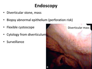 Bladder diverticulum | PPTX