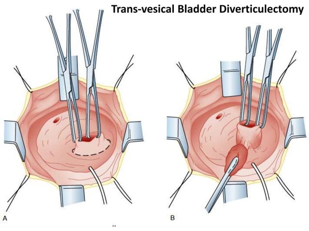 Bladder diverticulum | PPTX