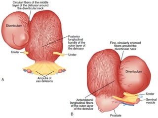 Bladder diverticulum | PPTX